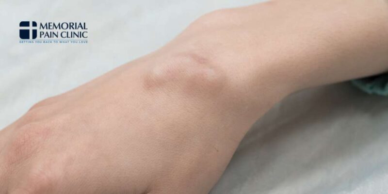 Pain in Hand and Fingers, Not Arthritis | Memorial Pain Clinic